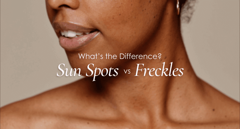 Spot the Difference: Sun Spots vs Freckles | Black Girl Sunscreen