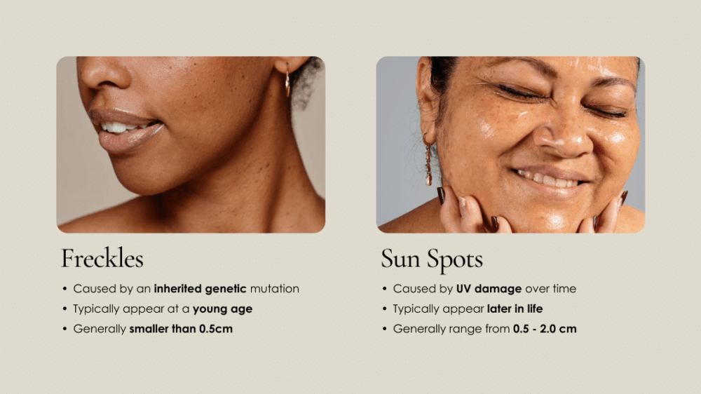 Spot the Difference: Sun Spots vs Freckles | Black Girl Sunscreen