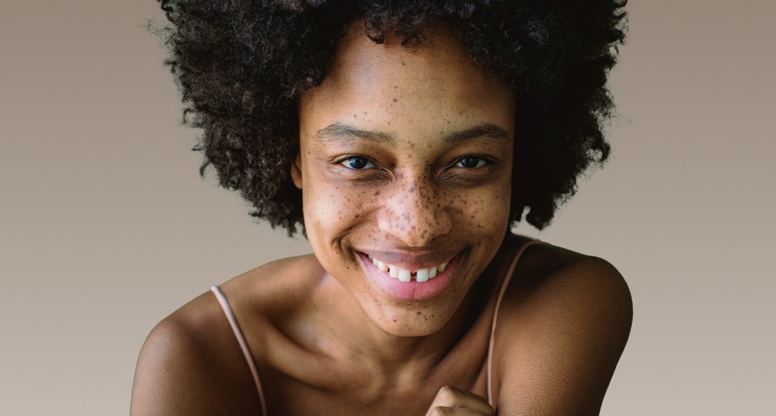 Spot the Difference: Sun Spots vs Freckles | Black Girl Sunscreen